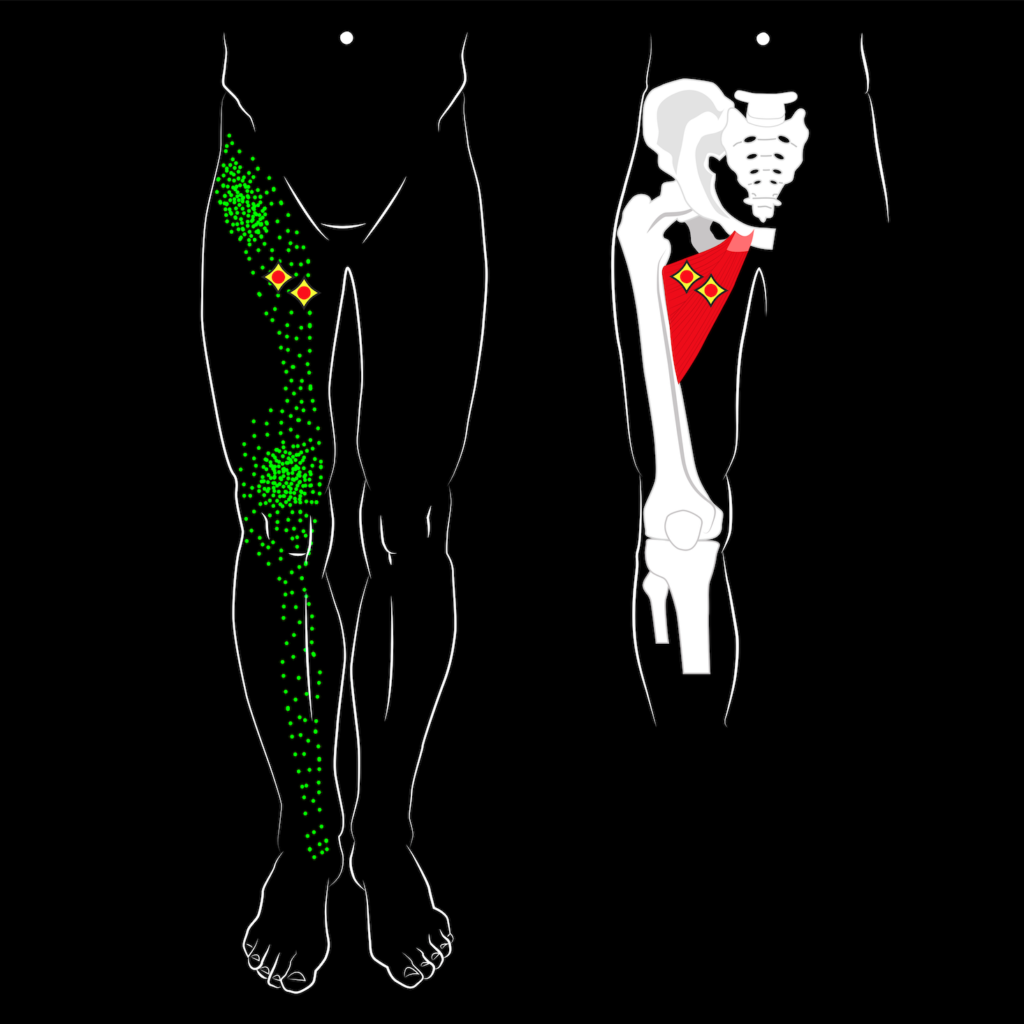 Adductor Injuries Hoppers Crossing Physiotherapy